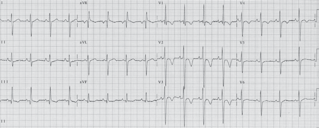 Right Ventricular Hypertrophy ECG | RVH ECG made easy – GMCMedicine