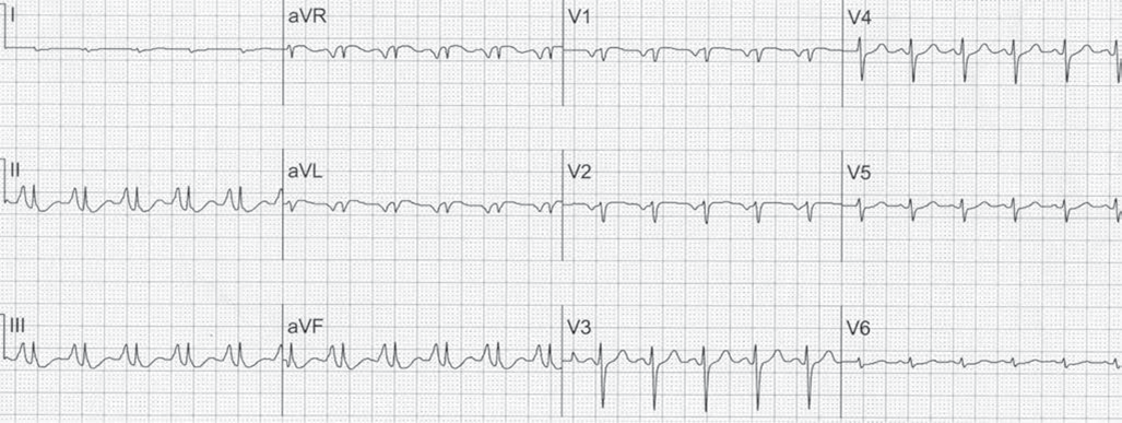 Right Ventricular Hypertrophy ECG | RVH ECG made easy – GMCMedicine