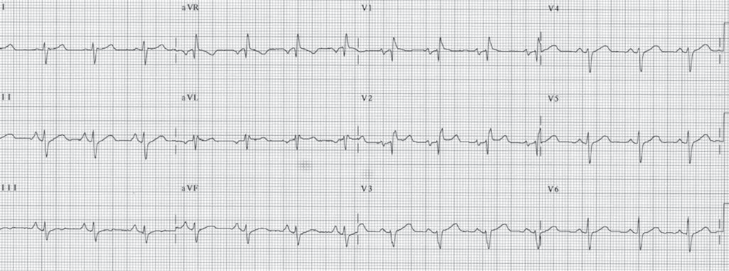 Right Ventricular Hypertrophy ECG | RVH ECG made easy – GMCMedicine
